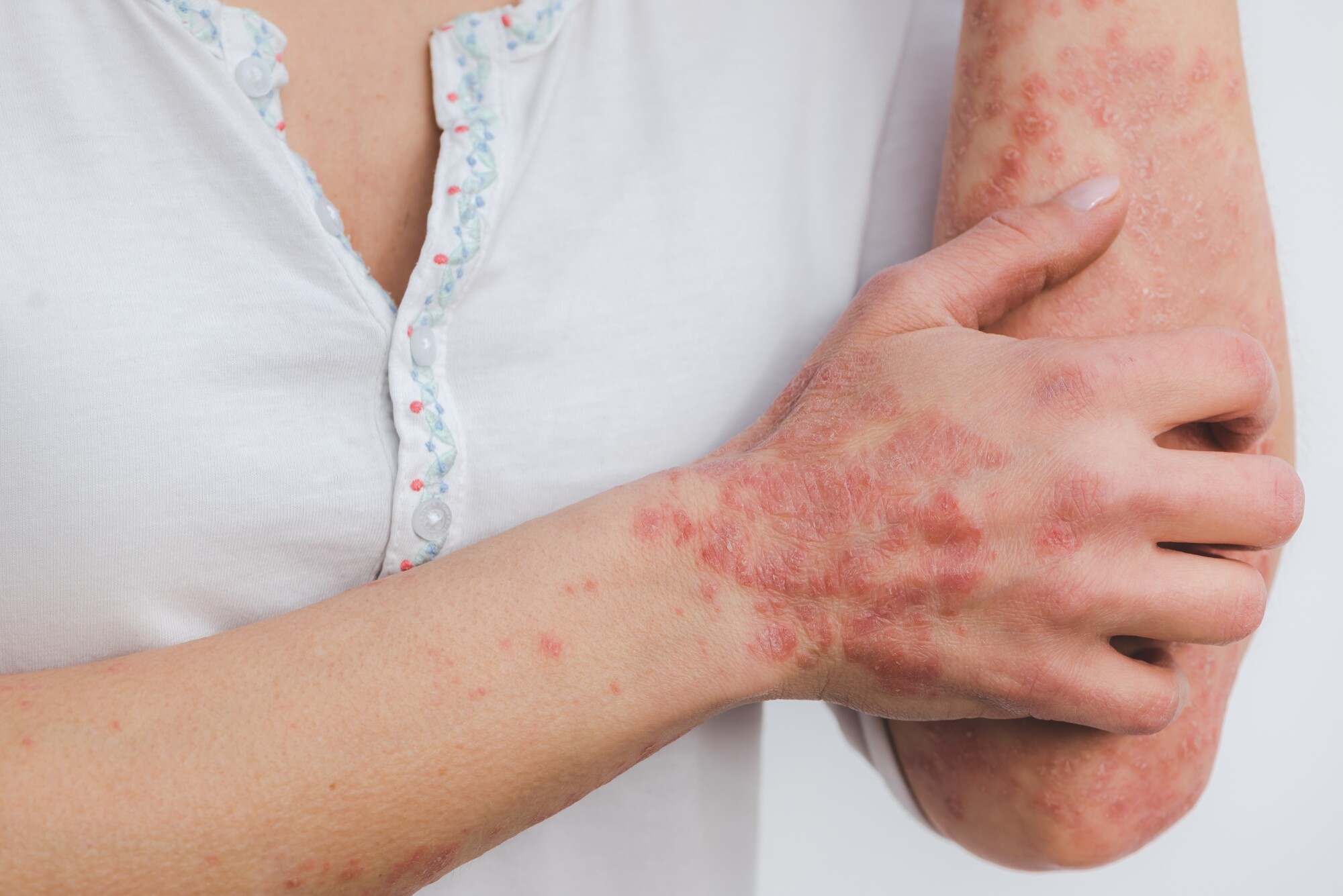 7 Remedies to Help Treat Skin Inflammation | Sequencing